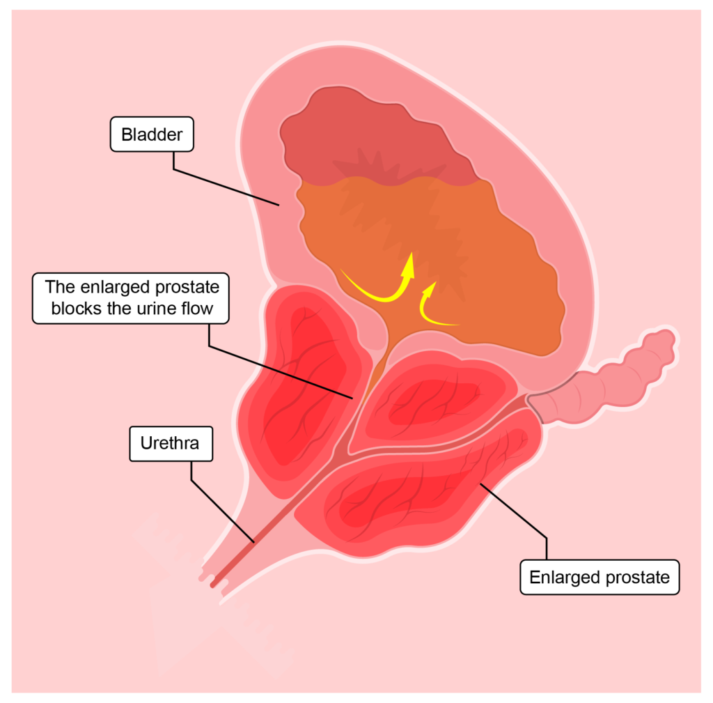 Benign Prostatic Hyperplasia - Frontier Healthcare Group