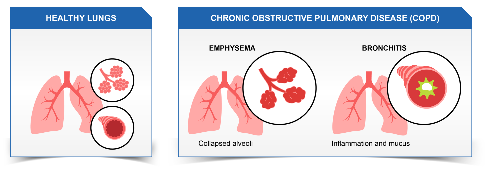 Chronic Obstructive Pulmonary Disease - Frontier Healthcare Group